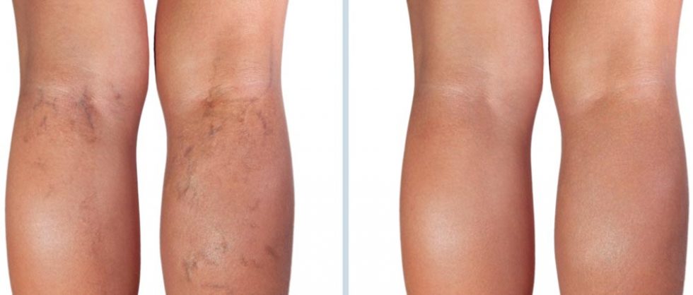Tratamiento de las Varices | clinicas varices murcia, clinica salzillo